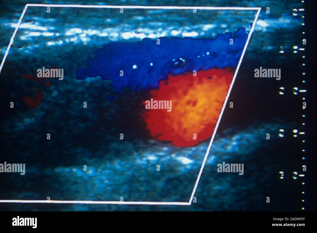 Thrombosed carotid artery. Coloured Doppler ultrasound scan of the ...