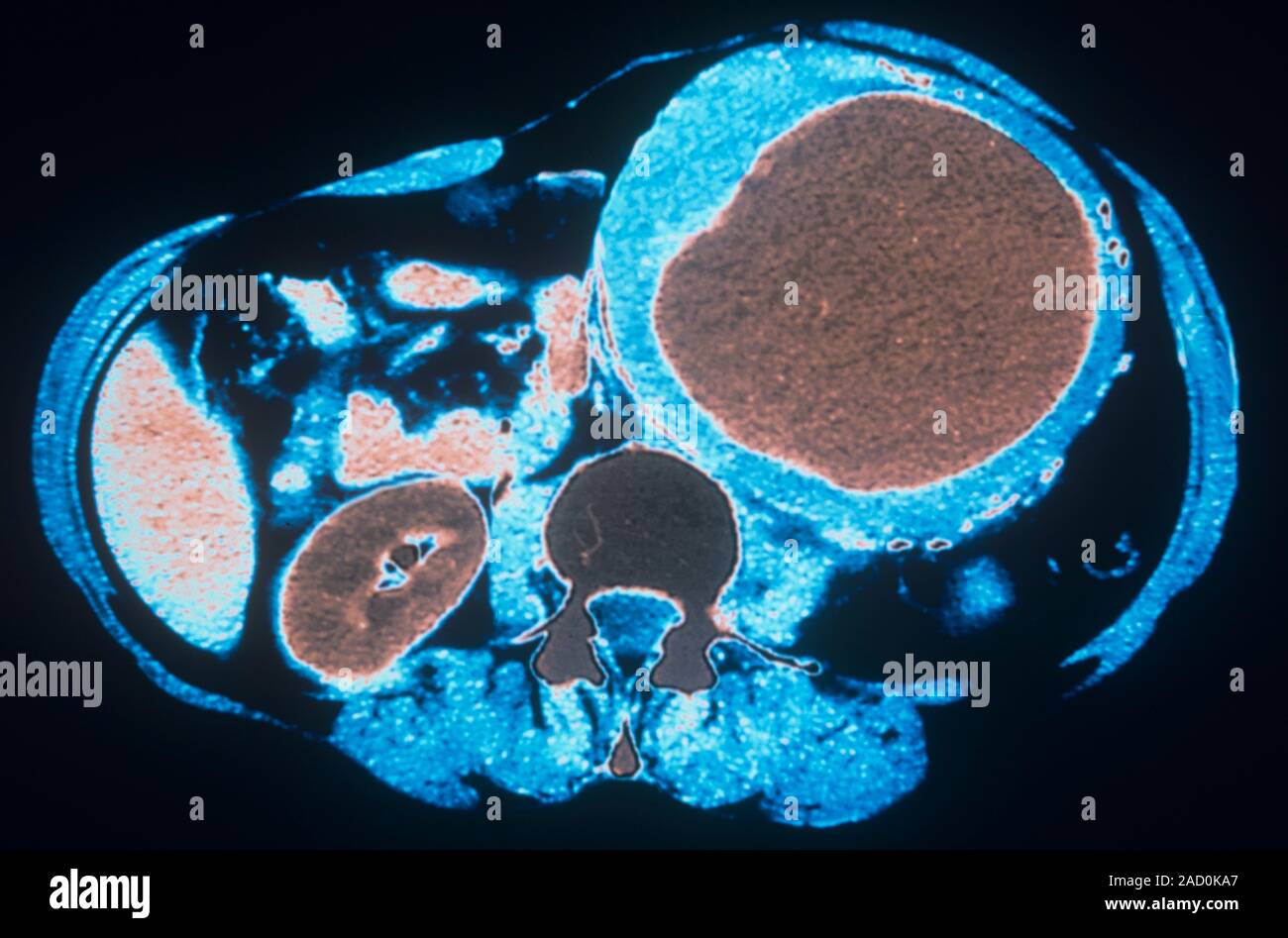 Aortic aneurysm. Coloured computed tomography (CT) scan of an axial section through the abdomen ...