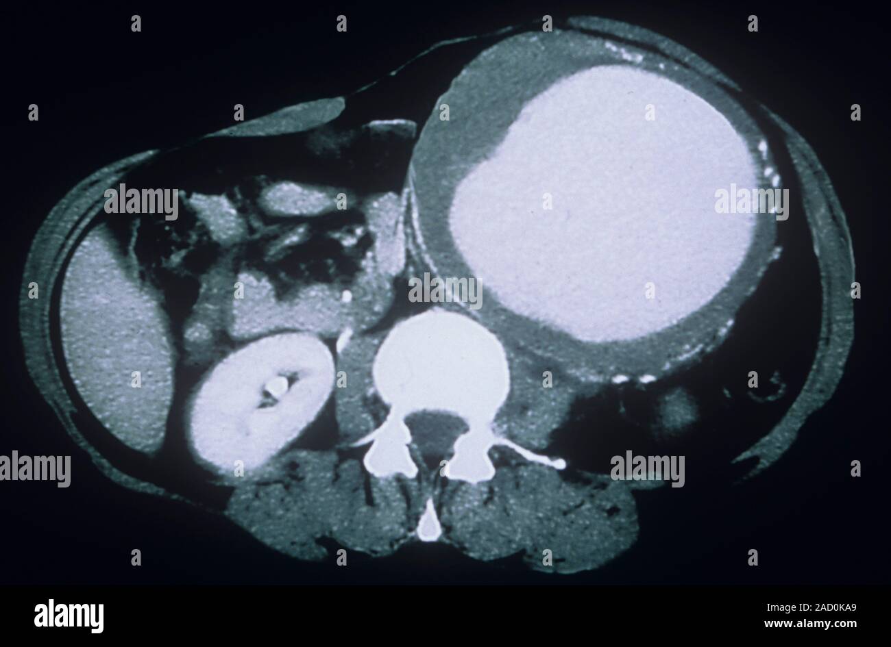 Aortic aneurysm. Computed tomography (CT) scan of an axial section ...