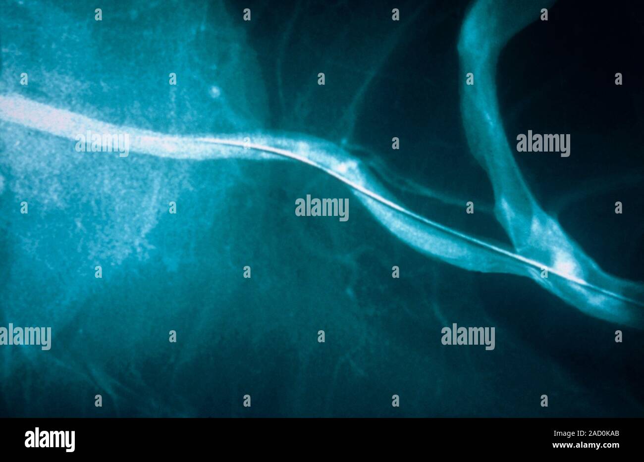 Vertebral artery post-angioplasty, X-ray. Digital angiogram of a ...