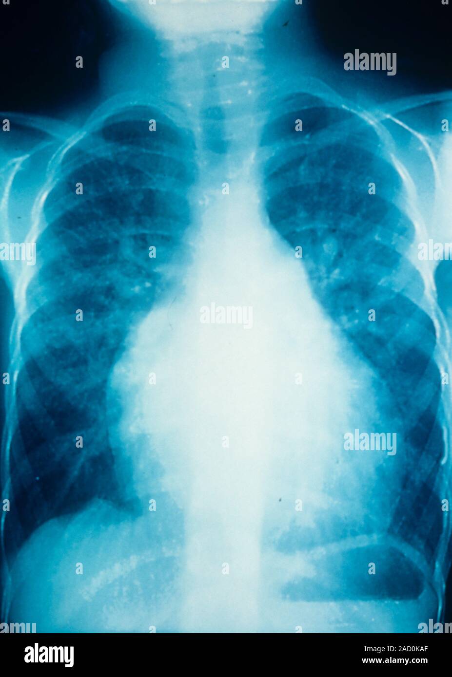 Enlarged heart. Coloured frontal X-ray of the chest of a 2-year-old ...