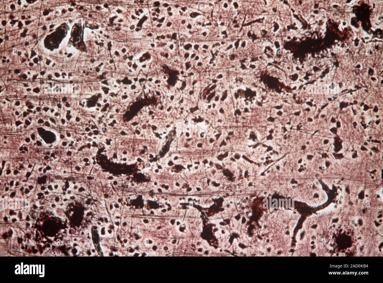 Brain in dementia. Light micrograph of a section through the cerebral ...