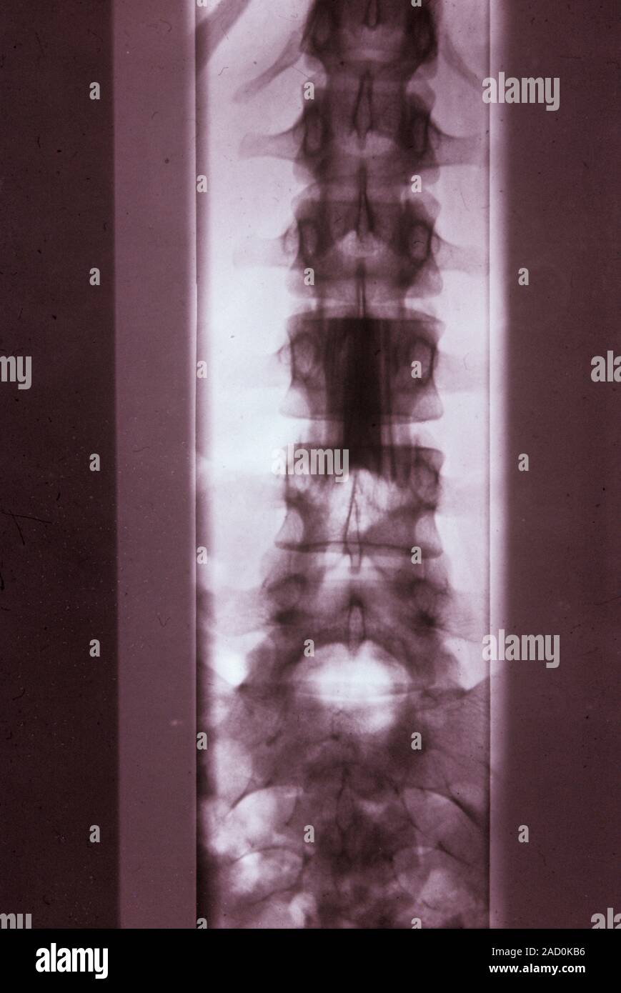 Spinal tumour. X-ray of the spine of a patient with an ependymoma ...