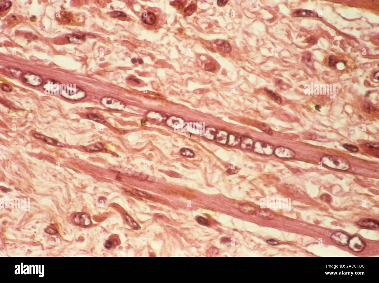 Muscle wasting in cancer. Light micrograph of a section through a ...