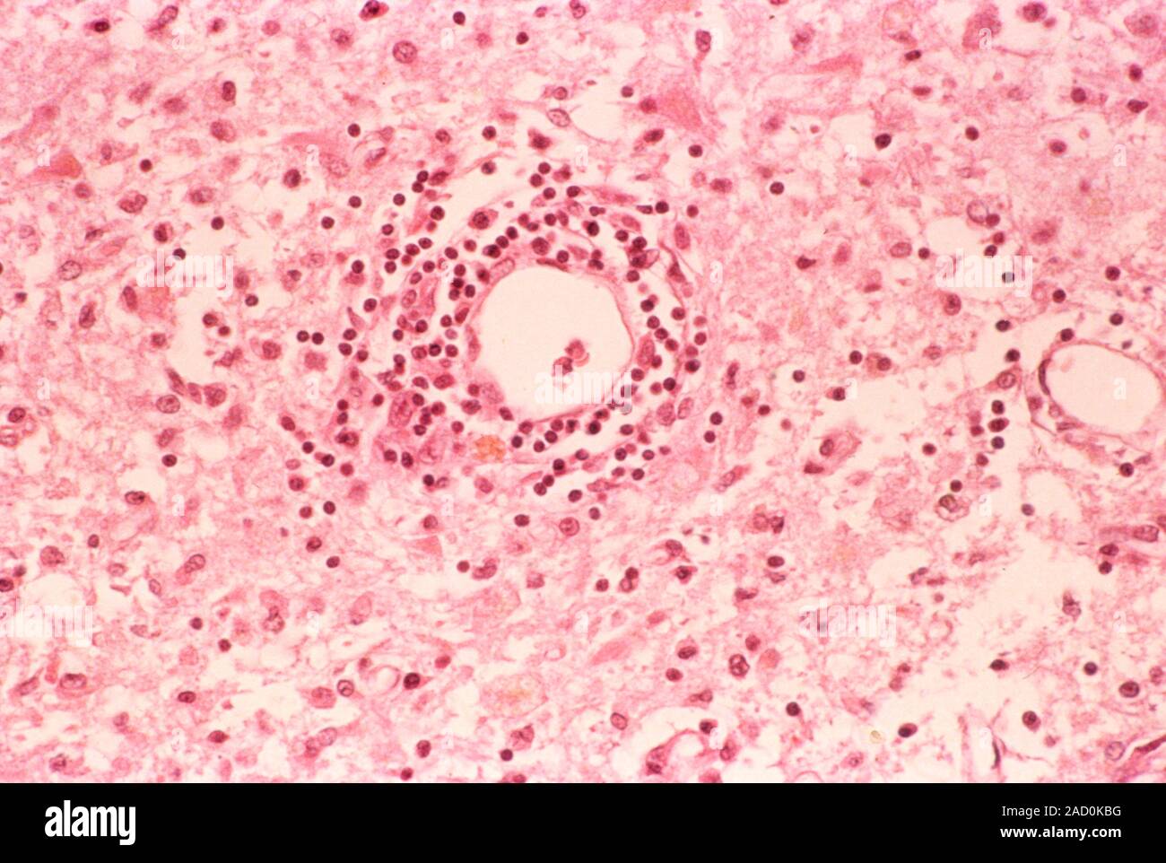 Viral encephalitis. Light micrograph of a section through brain tissue ...