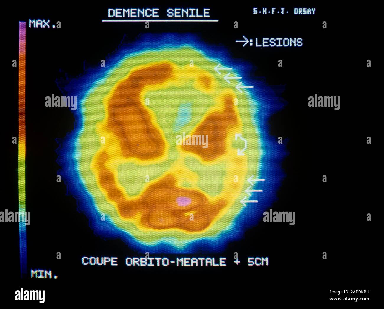 Brain in Alzheimer's disease. Positron emission tomography (PET) scan ...