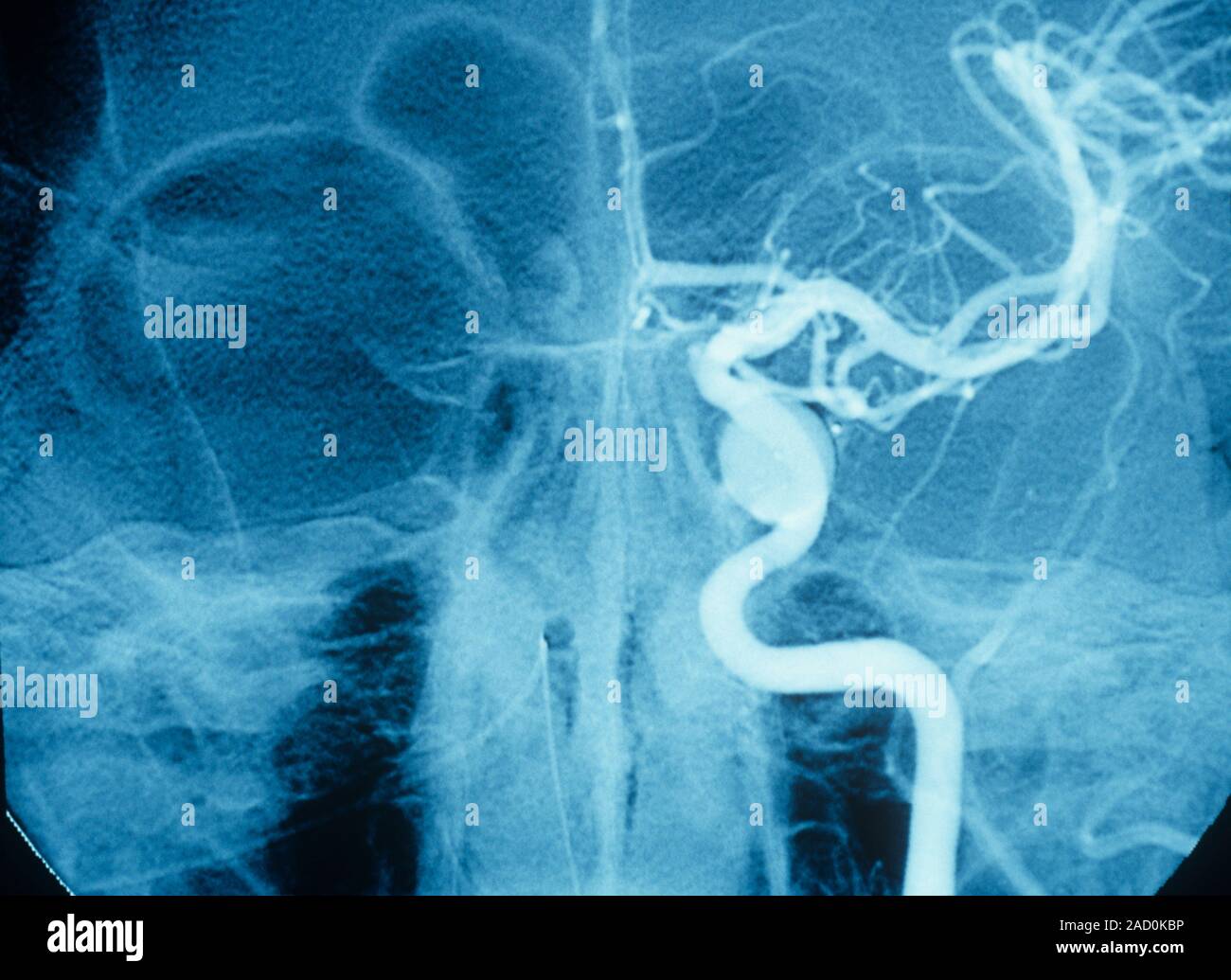 Treated carotid-cavernous fistula, X-ray. Angiogram of a carotid ...