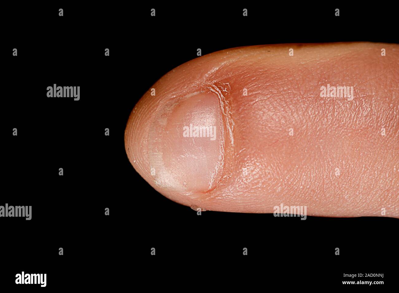 Fingernail psoriasis. Close-up of the finger of a 5-year-old child with ...