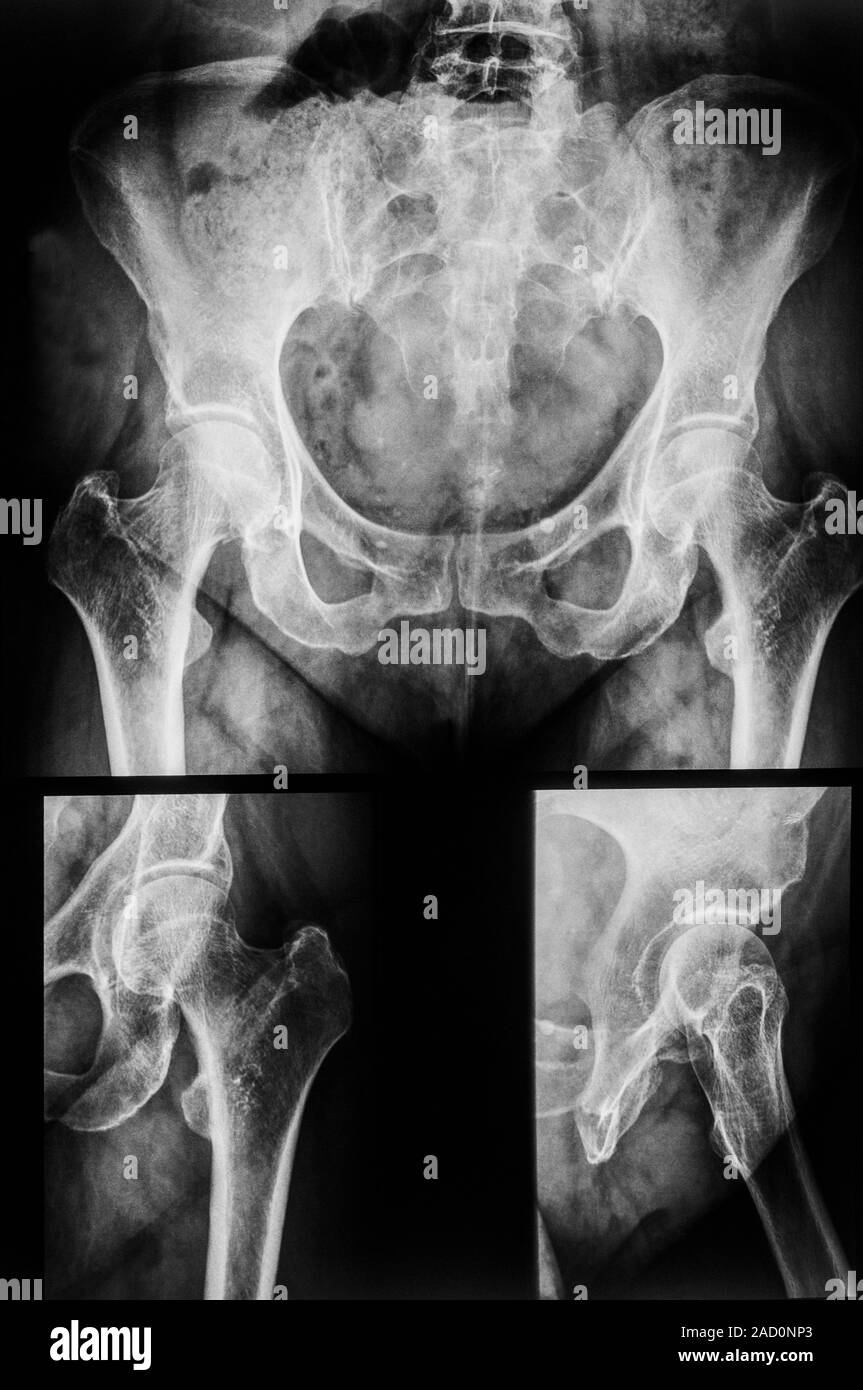 Diagnostic pelvis X-rays. Set of three X-rays of a human pelvis and hip ...