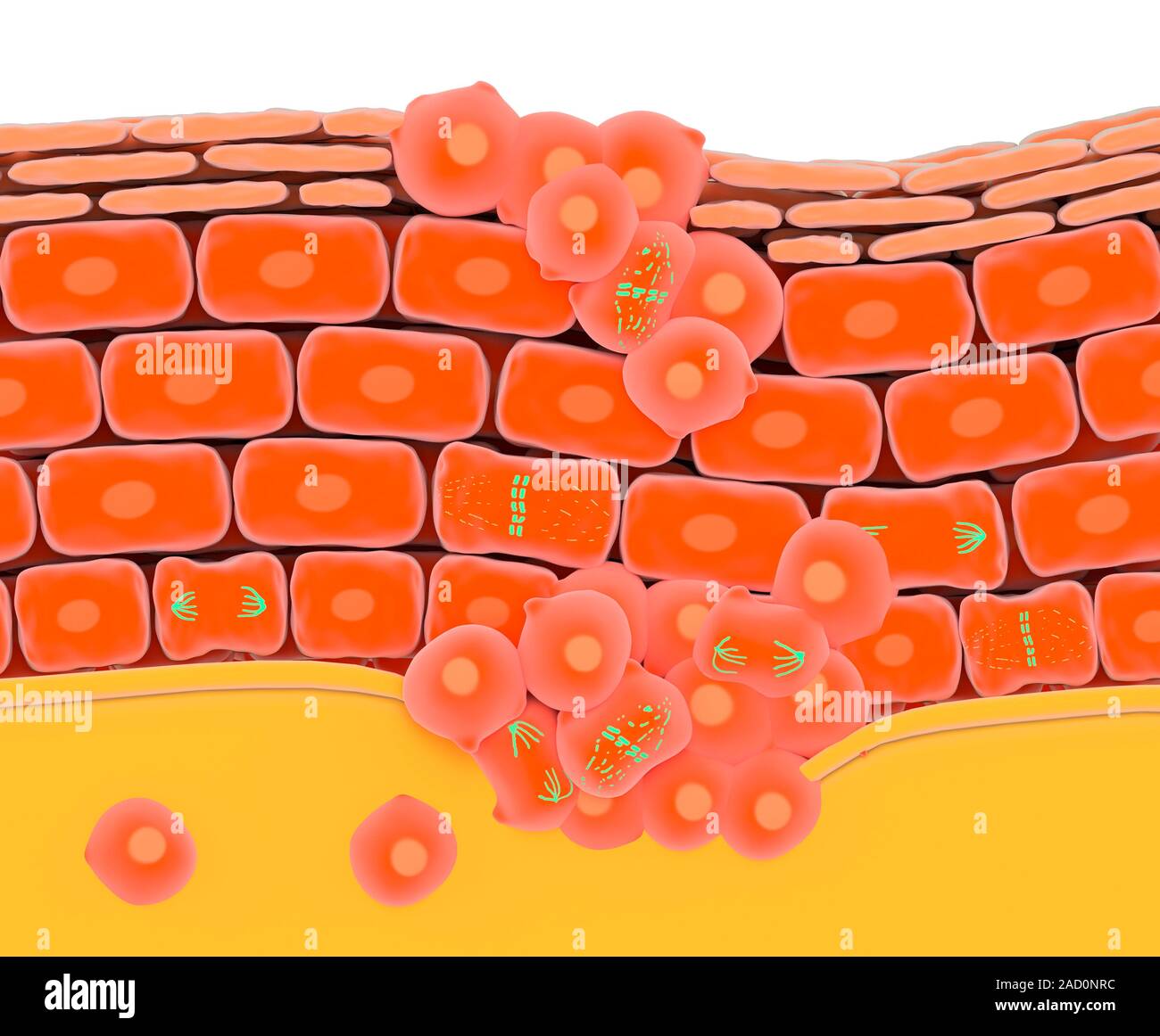 Cell division during skin cancer. Illustration of a vertical cross ...
