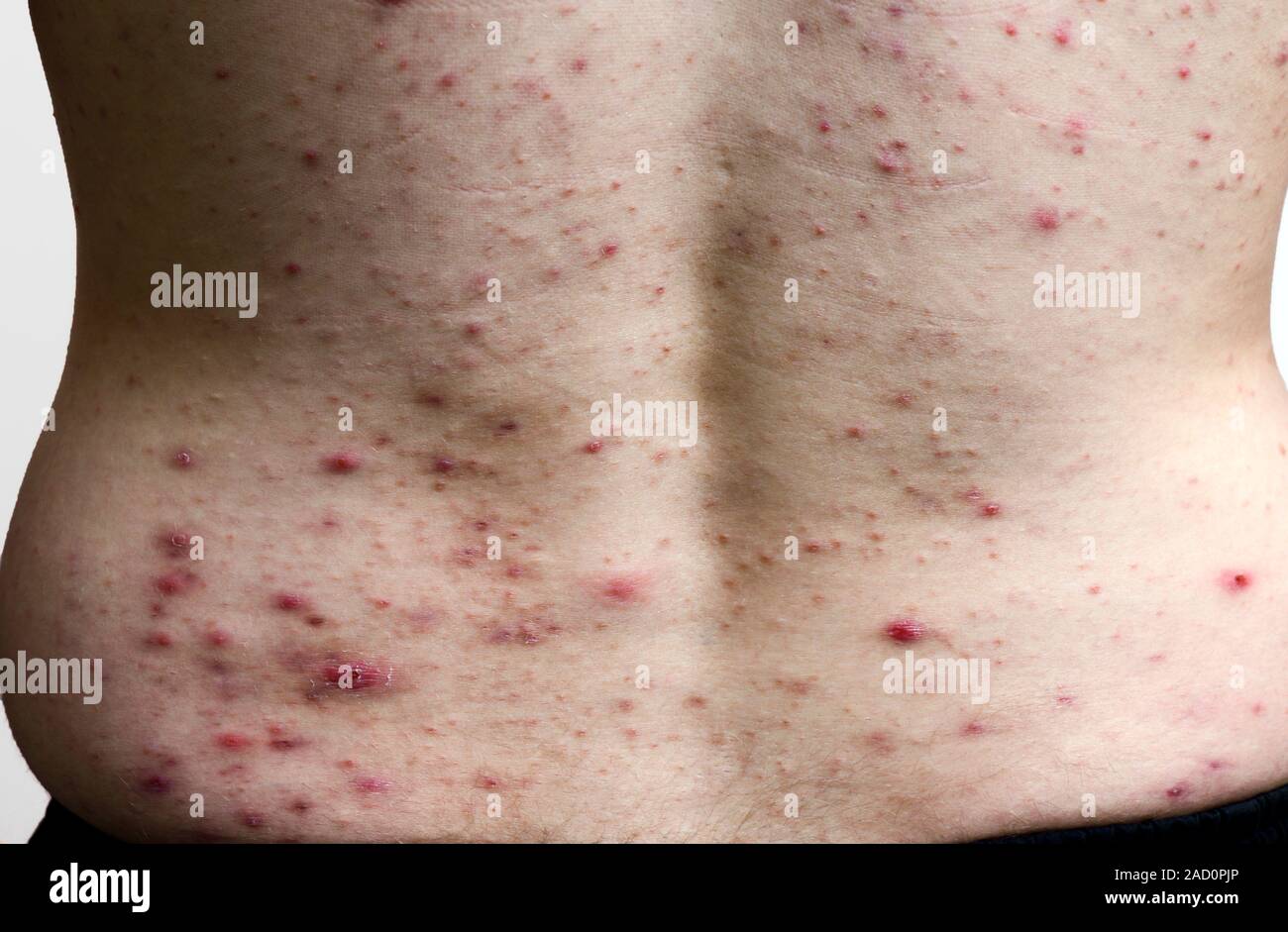 Not for use in Television Not for use in Television Acne. Close-up of ...