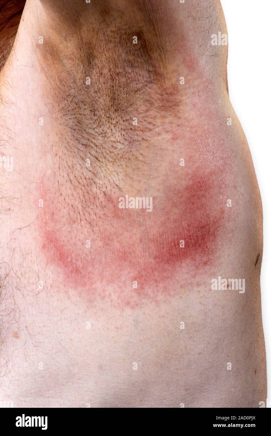Irritant Contact Dermatitis Armpit Atopic Eczema NHS