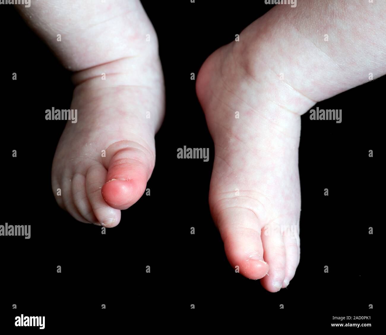 Not for use in Television Not for use in Television Swollen toe. Close ...