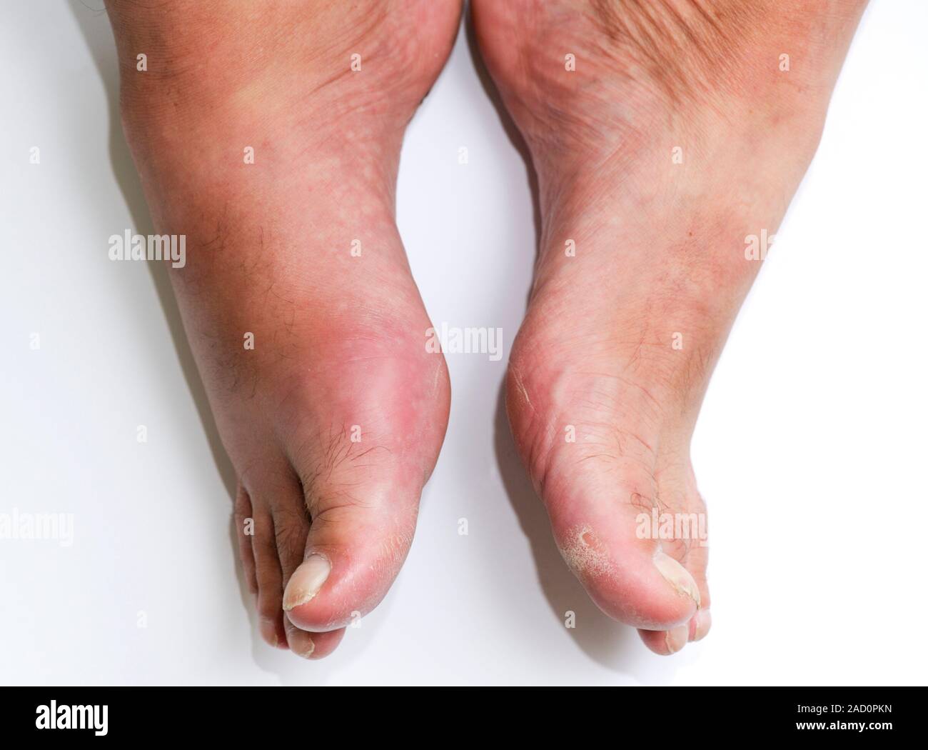 Not for use in Television Not for use in Television Gout of the big toe ...