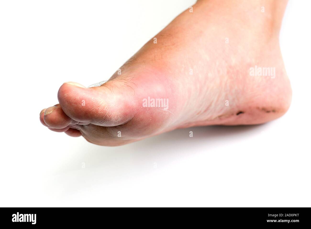 Not for use in Television Not for use in Television Gout of the big toe ...