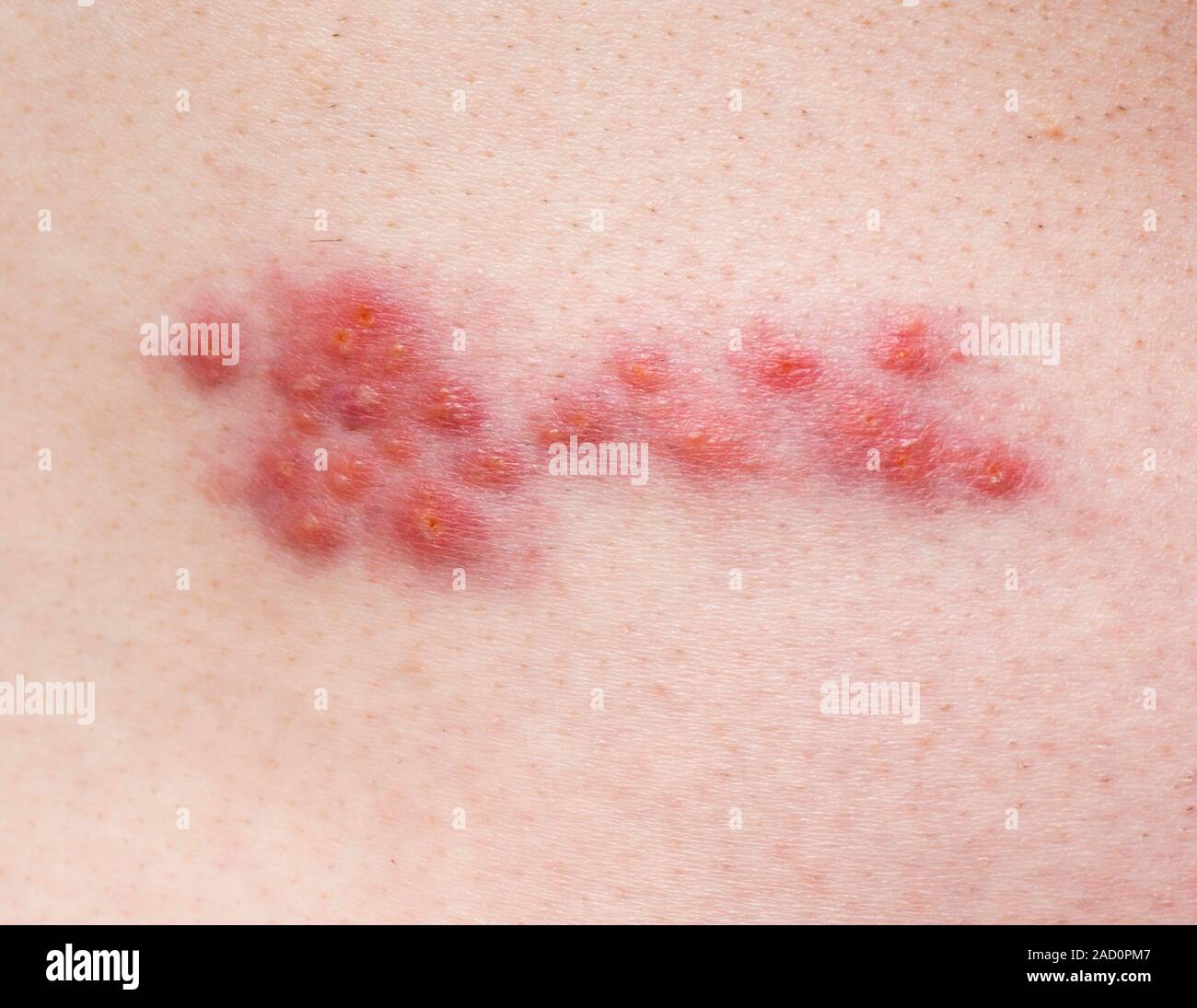 Not for use in Television Not for use in Television Shingles rash ...