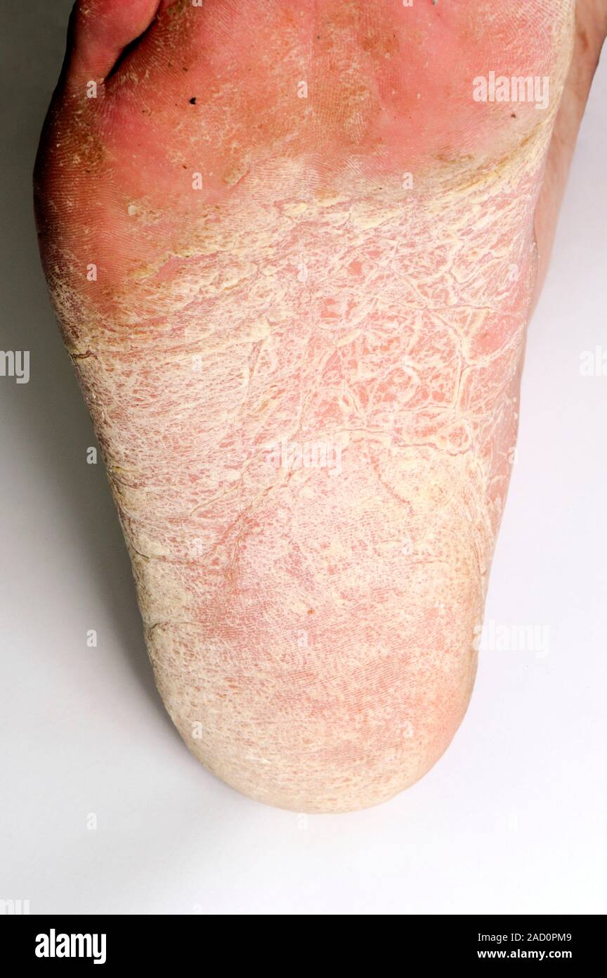 Not for use in Television Not for use in Television Eczema of the foot ...