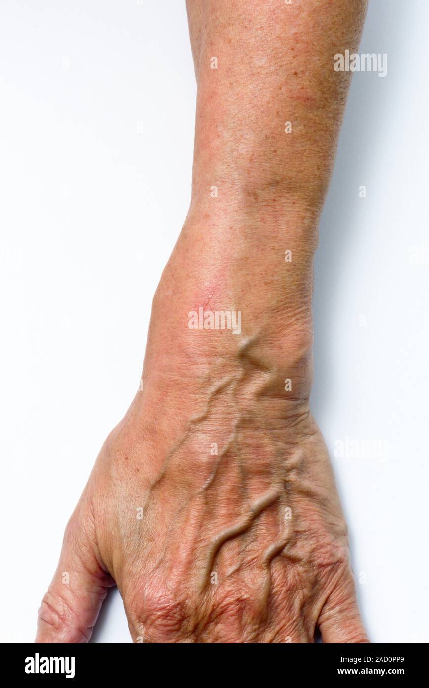 Not for use in Television Not for use in Television Tenosynovitis of ...