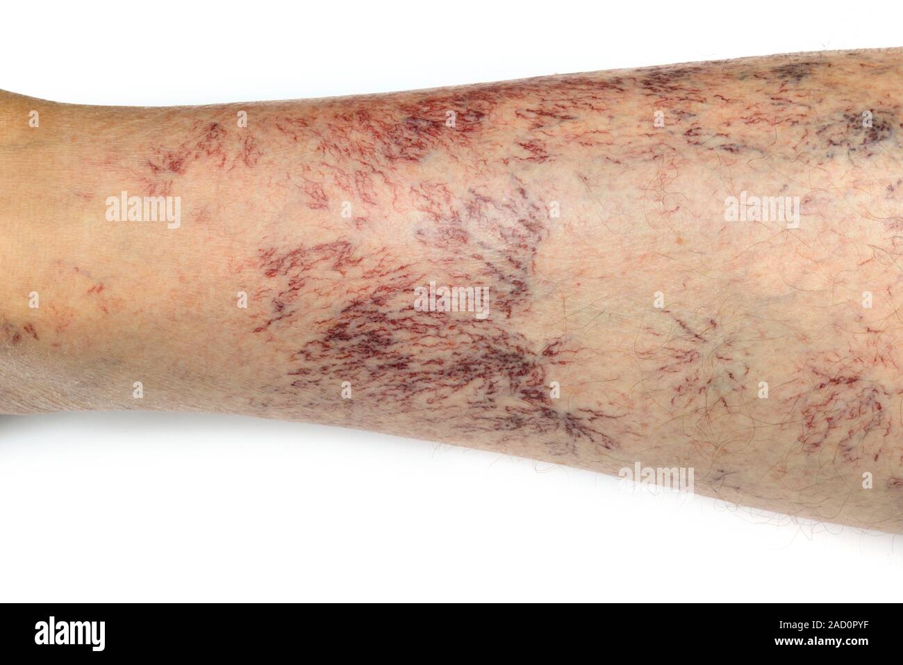 Not for use in Television Not for use in Television Telangiectasia ...