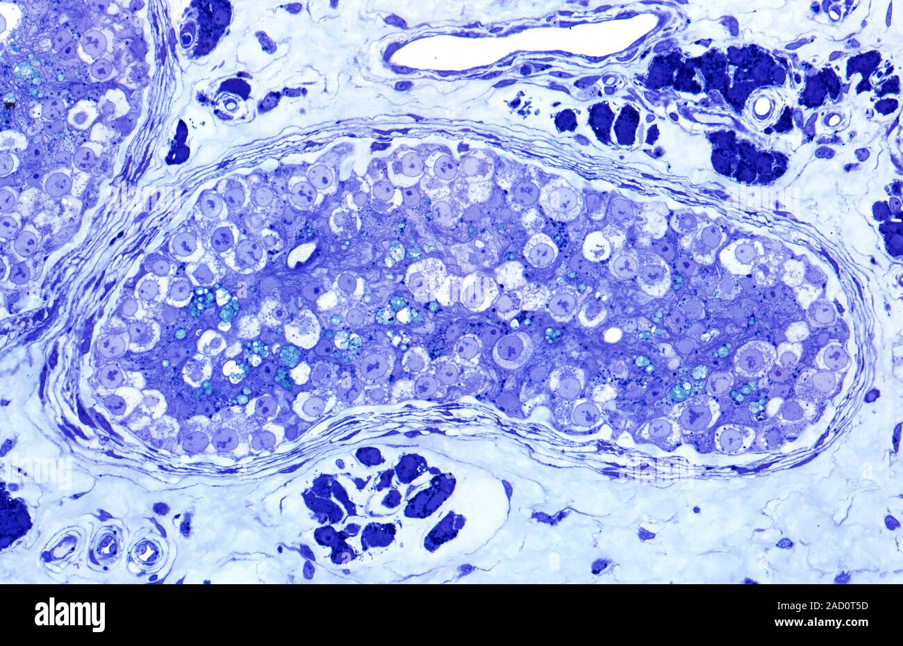 Light microscopy of precursor cancer cells in the adult human testis ...