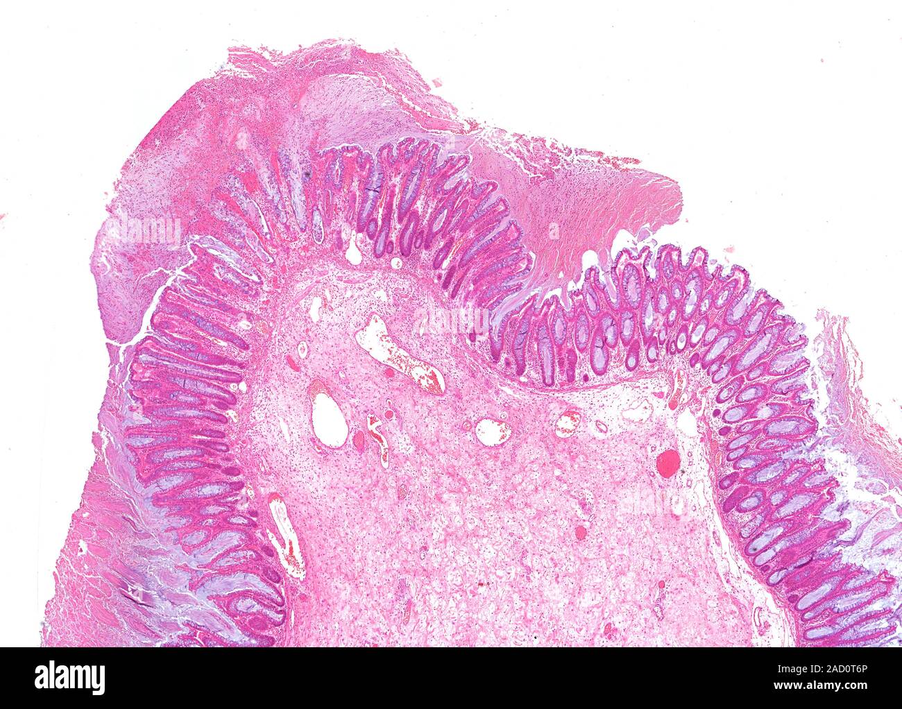 Light microscopy of colitis of the human large bowel. This is an ...