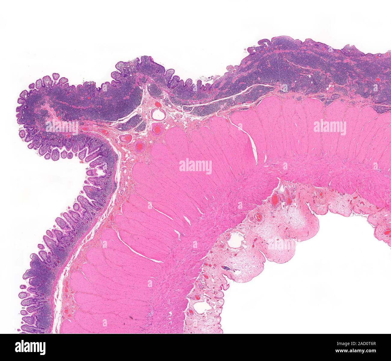 Light microscopy of a lymphoma of the human small bowel. Lymphoma of ...