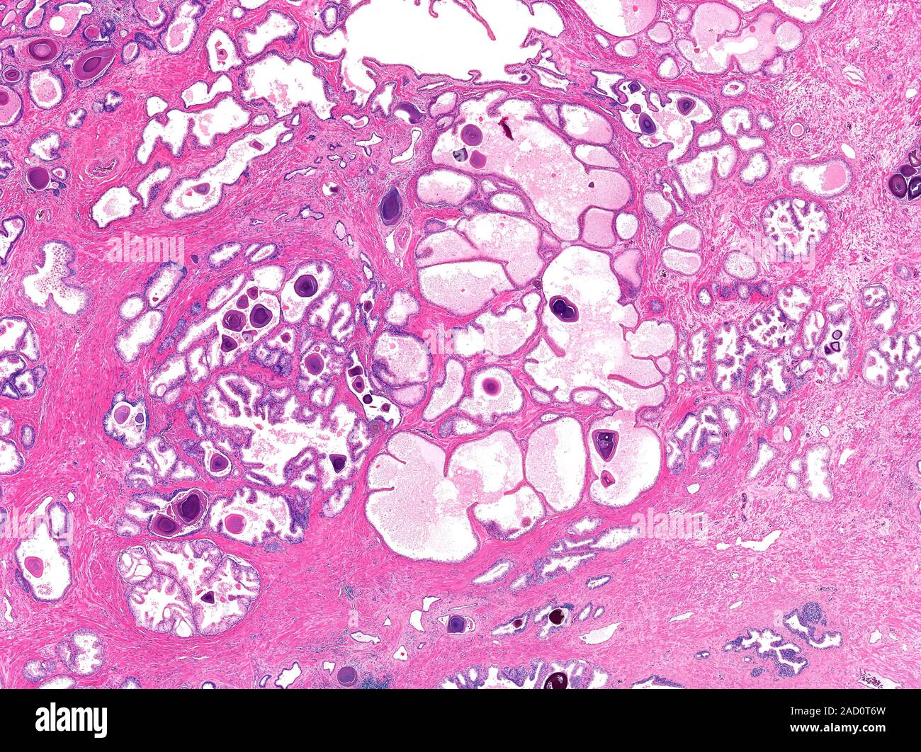 Light microscopy of human prostate gland showing typical tubular and ...