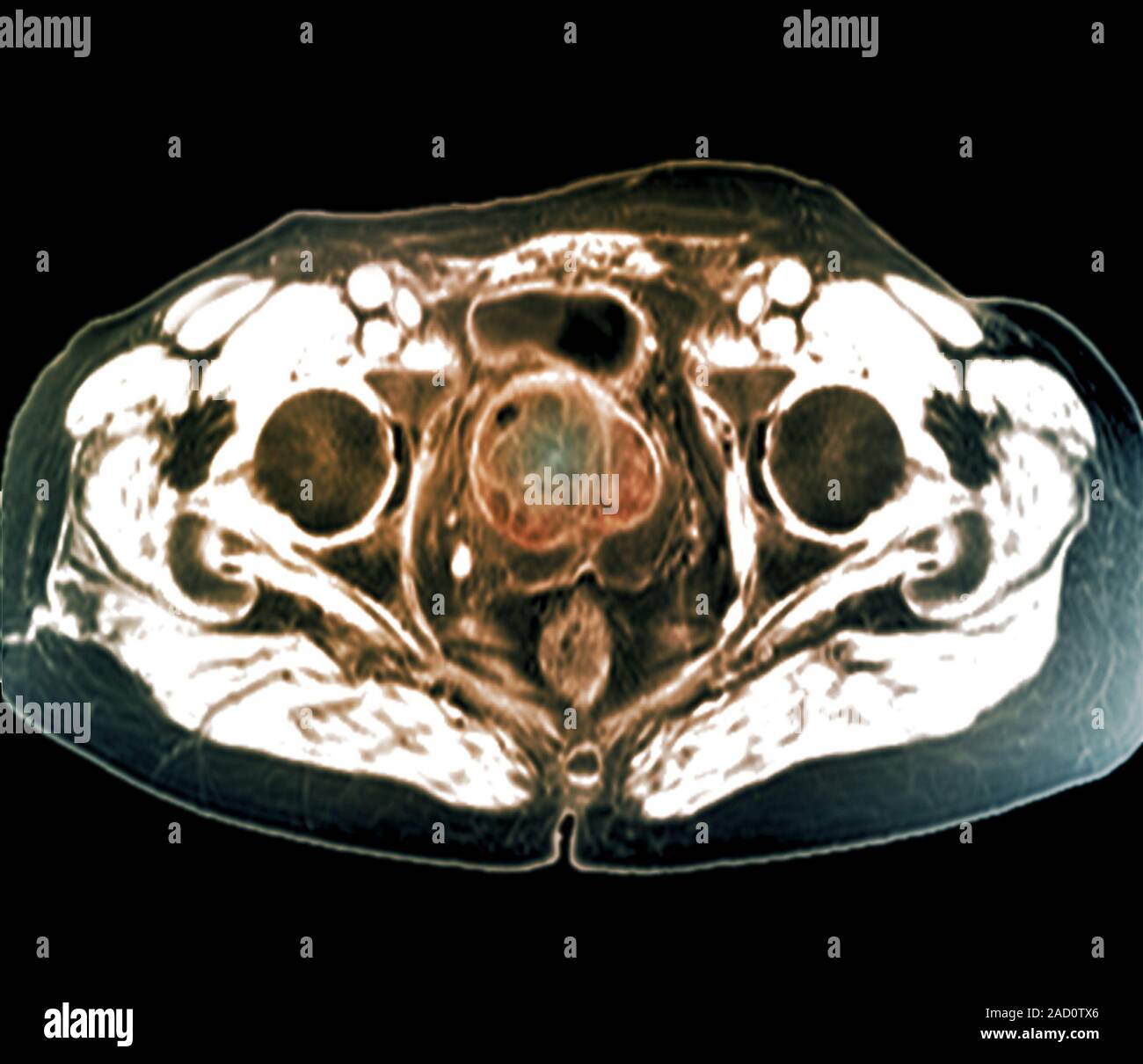 Benign prostatic hyperplasia. Magnetic resonance imaging (MRI) scan of ...