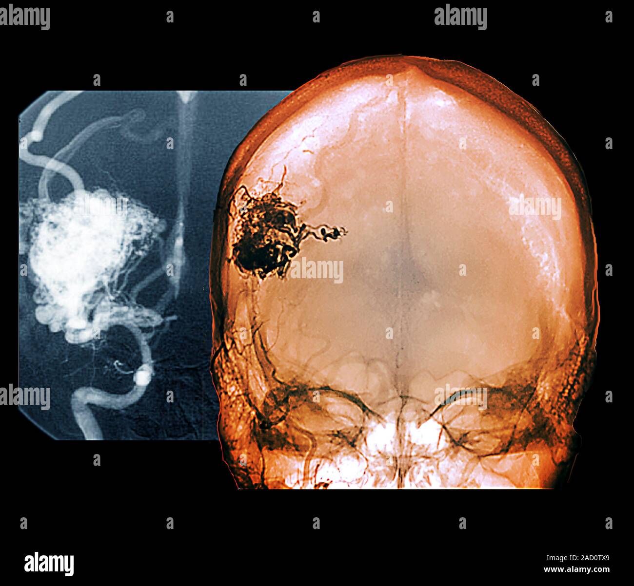 Brain blood vessel malformation. Coloured computed tomography (CT) scan (right) and angiogram (X ...