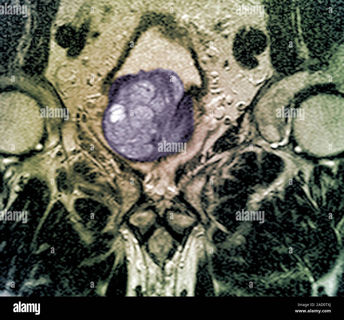 Benign prostatic hyperplasia. Magnetic resonance imaging (MRI) scan of ...