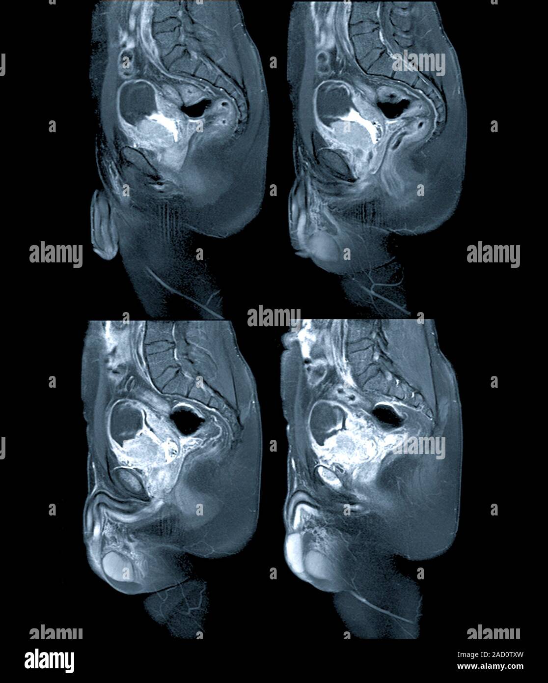 Metastatic bladder cancer. Magnetic resonance imaging (MRI) scans of ...