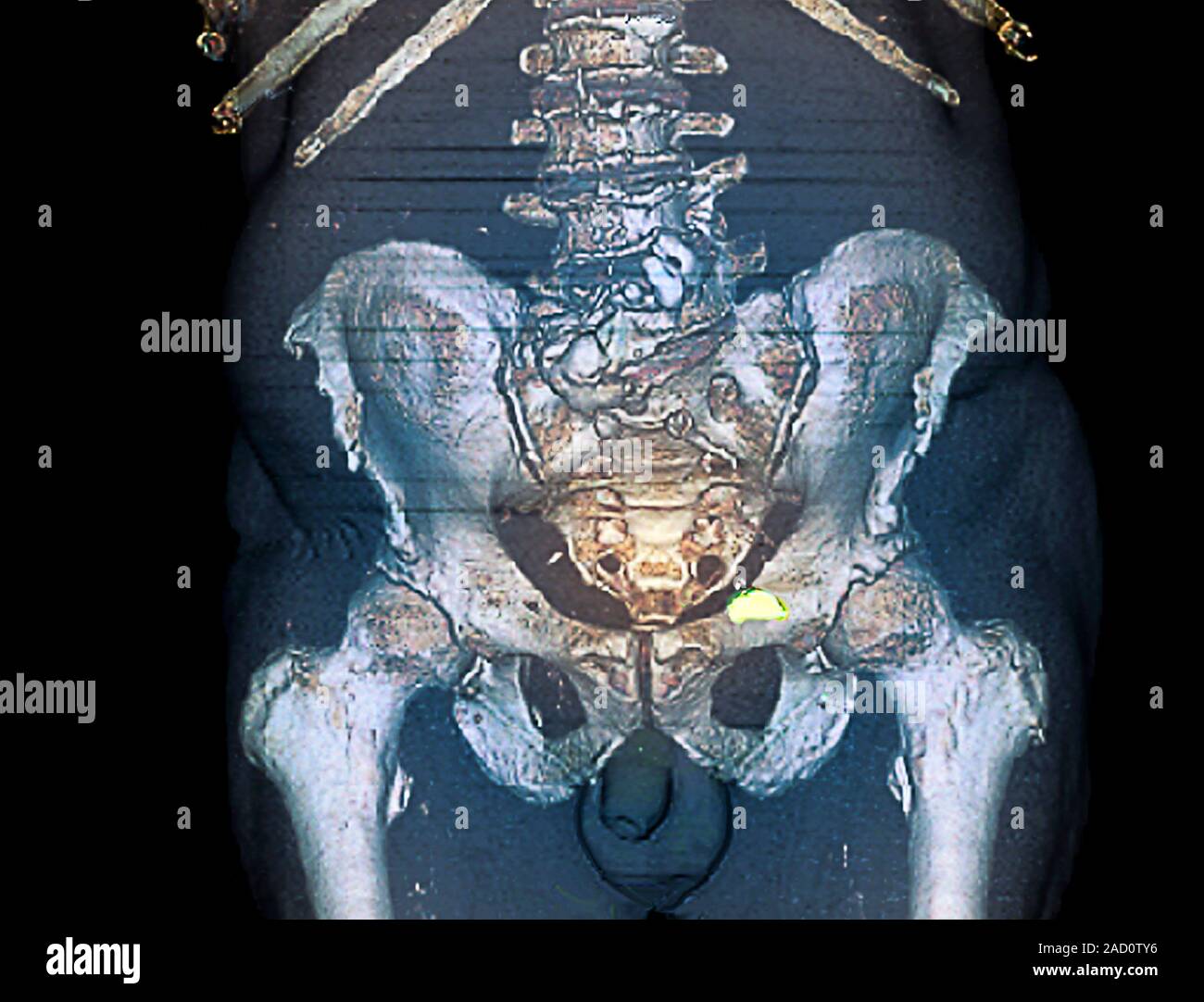 Metastatic prostate cancer. Coloured 3D computed tomography (CT) scan ...