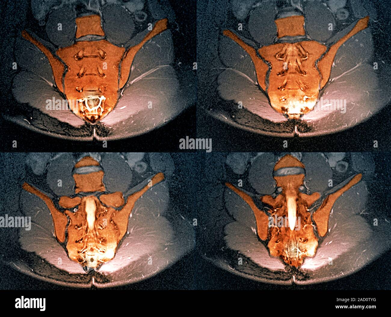 Normal sacrum. Coloured magnetic resonance imaging (MRI) scans of sections through the pelvis of ...