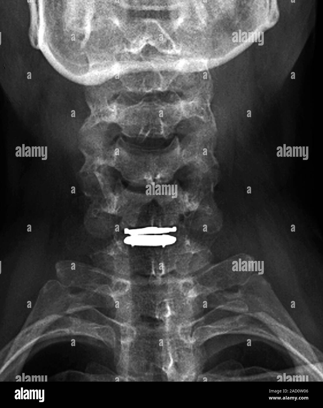 Spinal disc implant. X-ray of a section through the neck of a 38-year ...