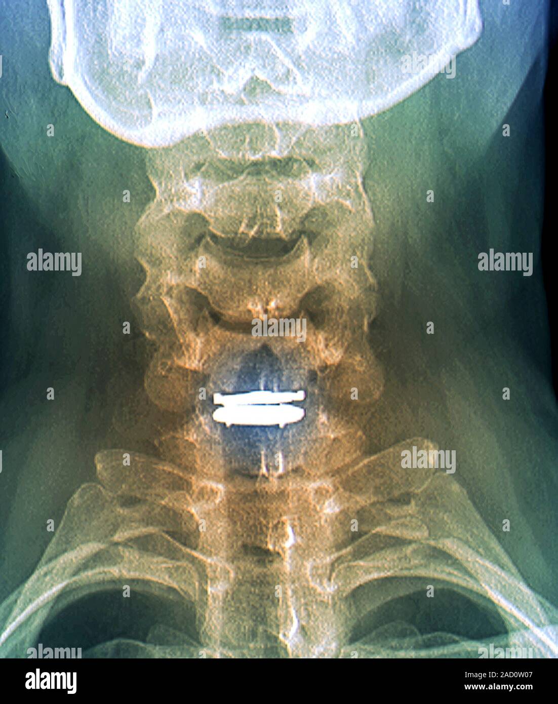 Spinal disc implant. X-ray of a section through the neck of a 38-year ...