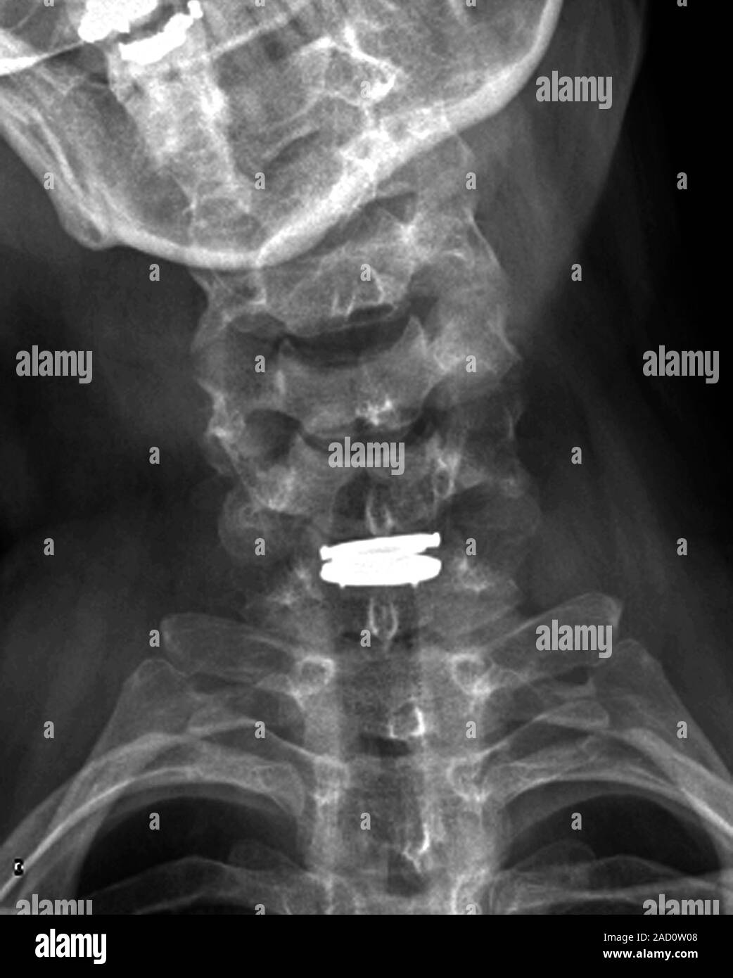 Spinal disc implant. X-ray of a section through the neck of a 38-year ...