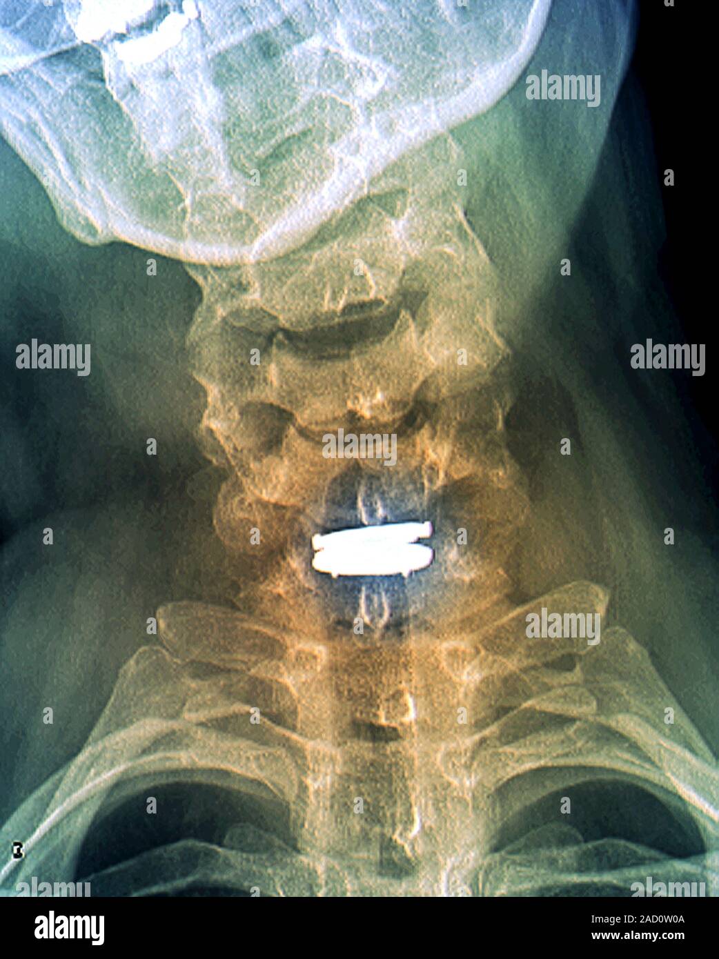 Spinal disc implant. X-ray of a section through the neck of a 38-year ...