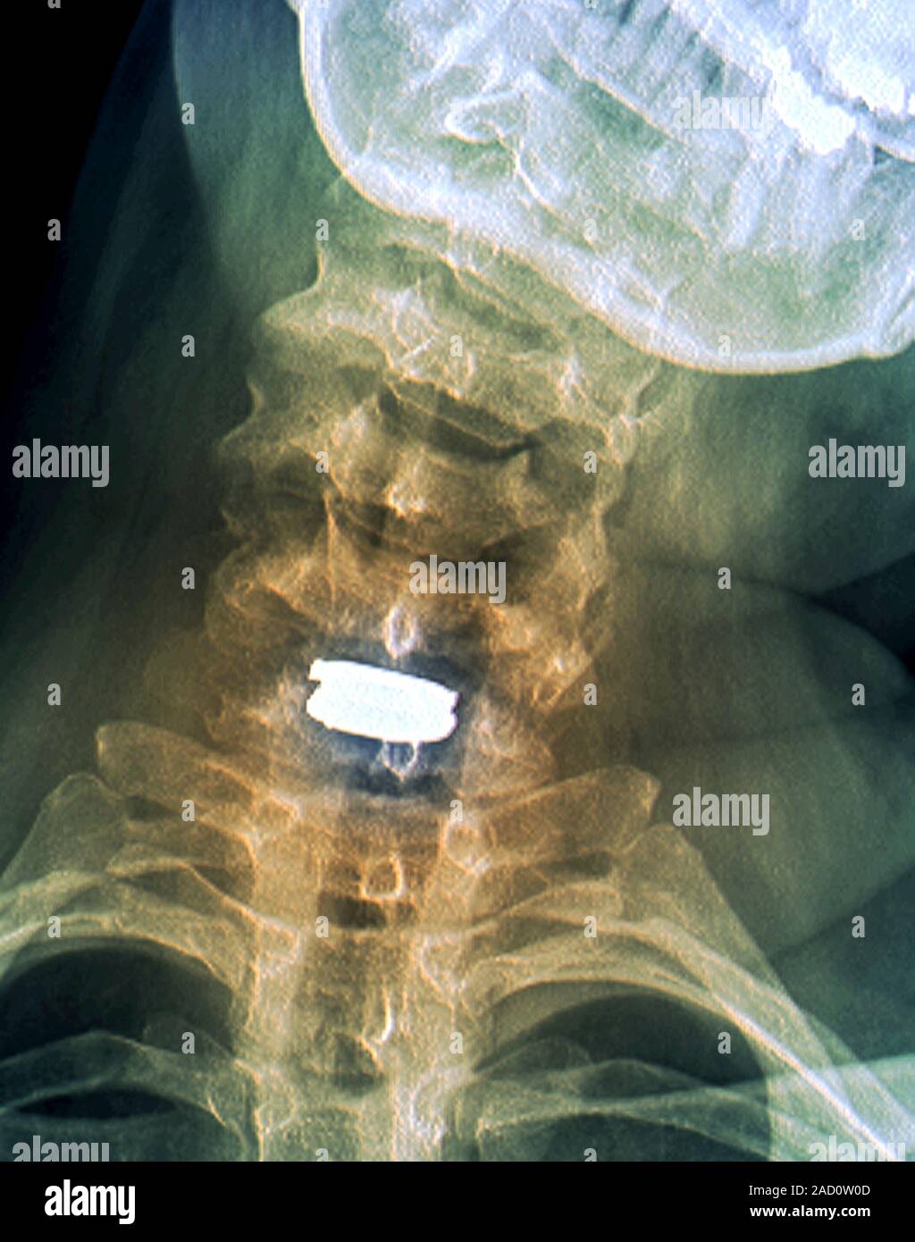 Spinal disc implant. X-ray of a section through the neck of a 38-year ...