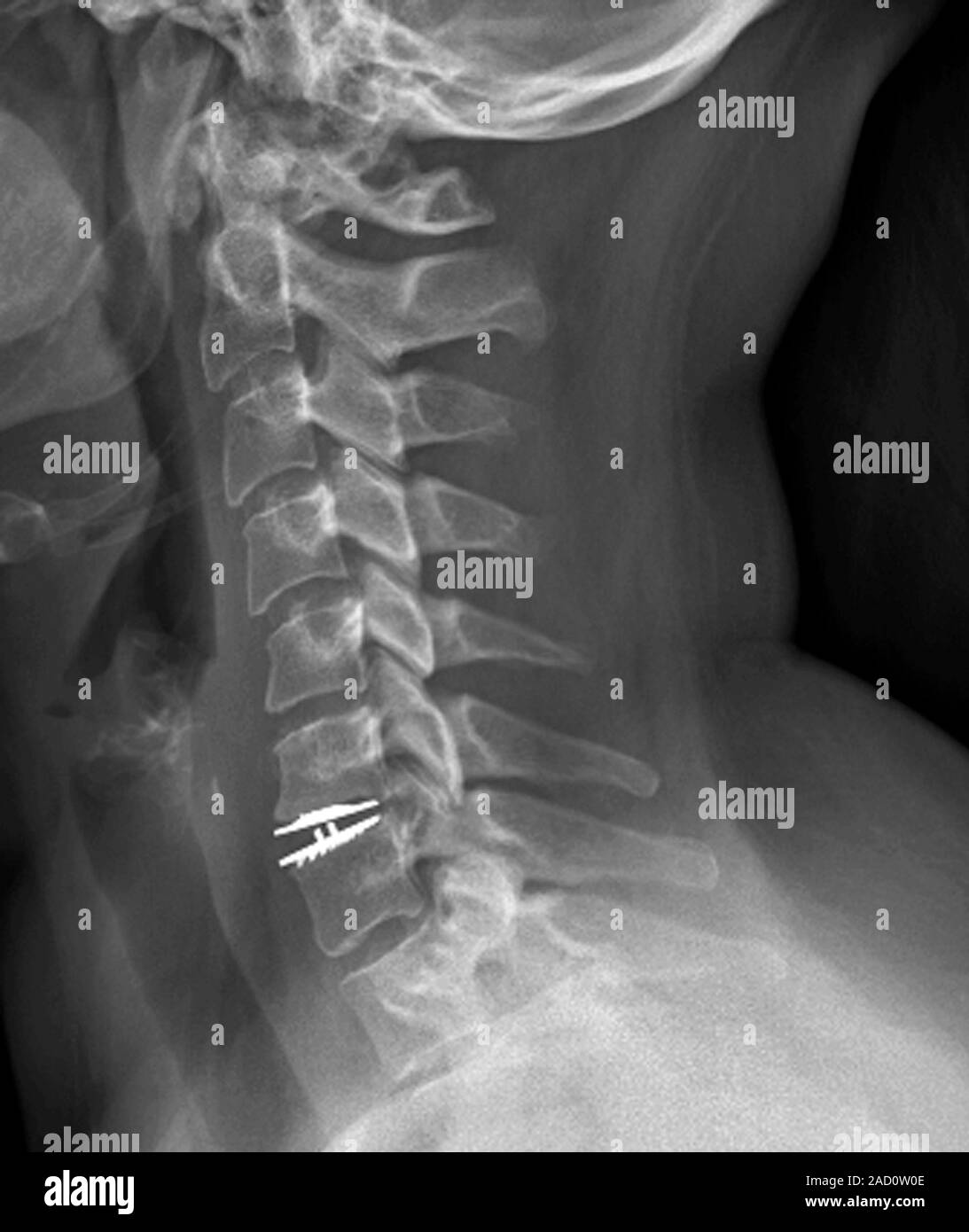 Spinal disc implant. X-ray of a section through the neck of a 38-year ...