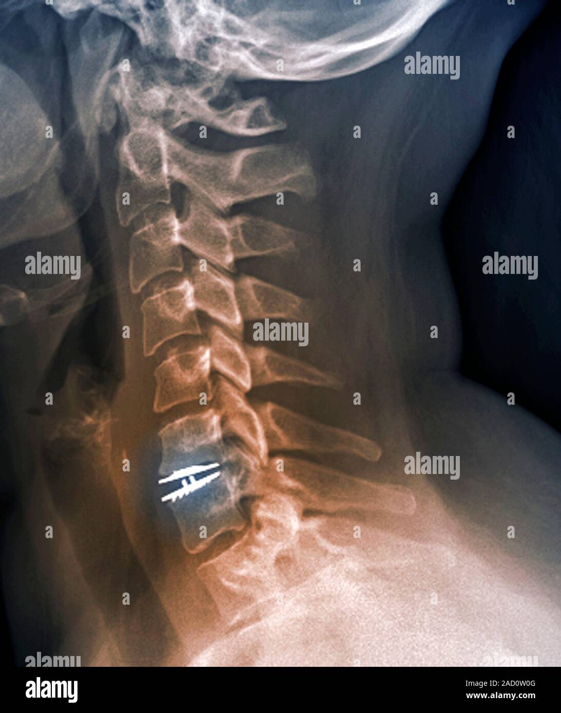 Spinal disc implant. X-ray of a section through the neck of a 38-year ...