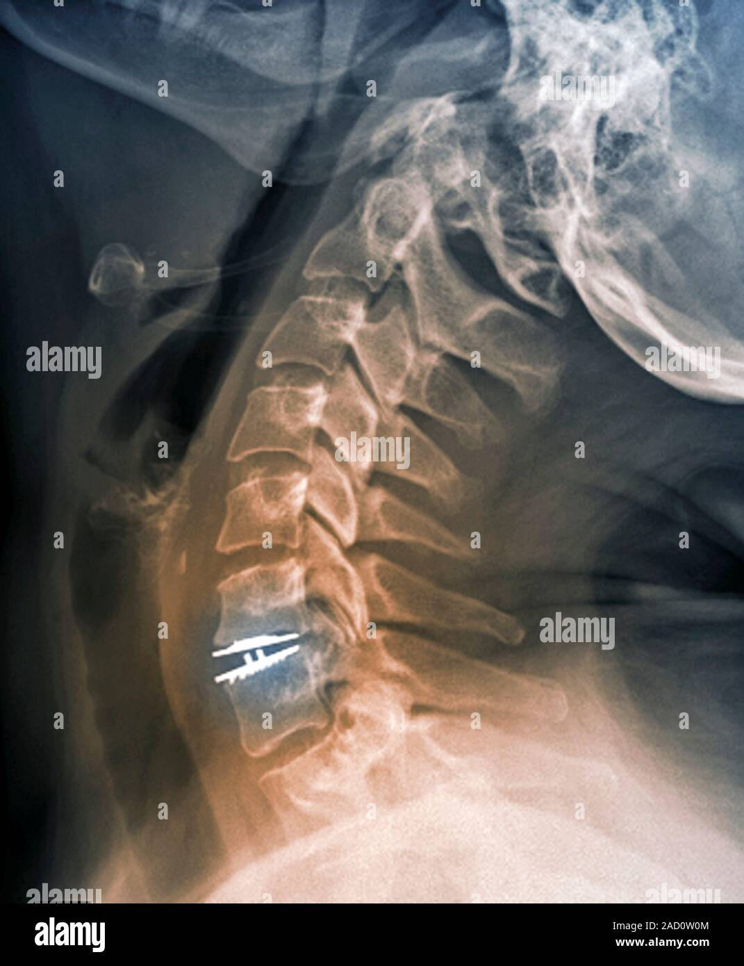 Spinal disc implant. X-ray of a section through the neck of a 38-year ...