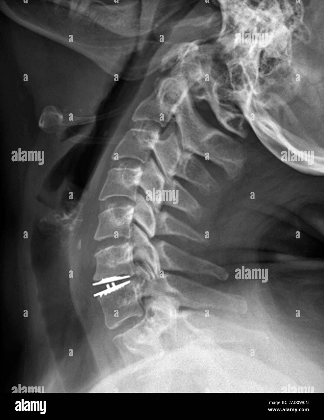 Spinal disc implant. X-ray of a section through the neck of a 38-year ...