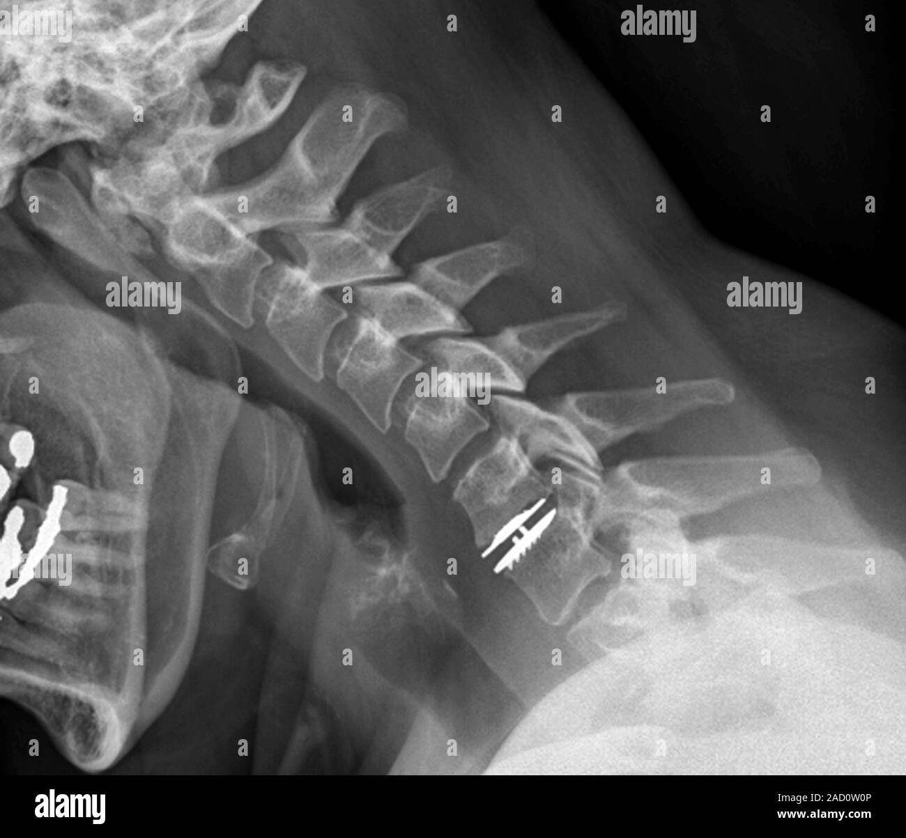Spinal disc implant. X-ray of a section through the neck of a 38-year ...