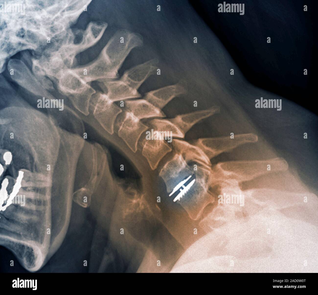 Spinal disc implant. X-ray of a section through the neck of a 38-year ...