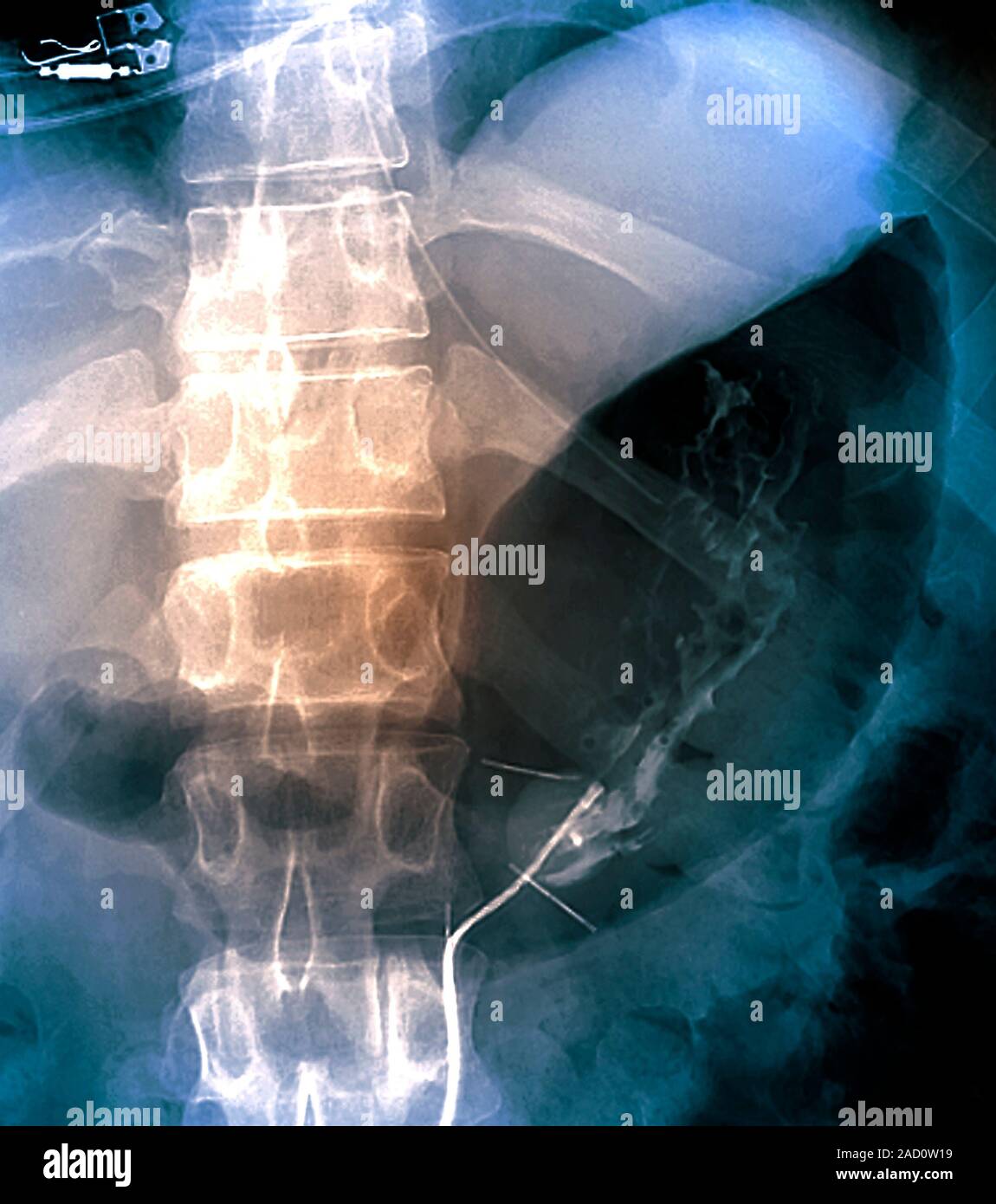 Stomach feeding tube in cancer. Coloured fluoroscopic X-ray image of a ...