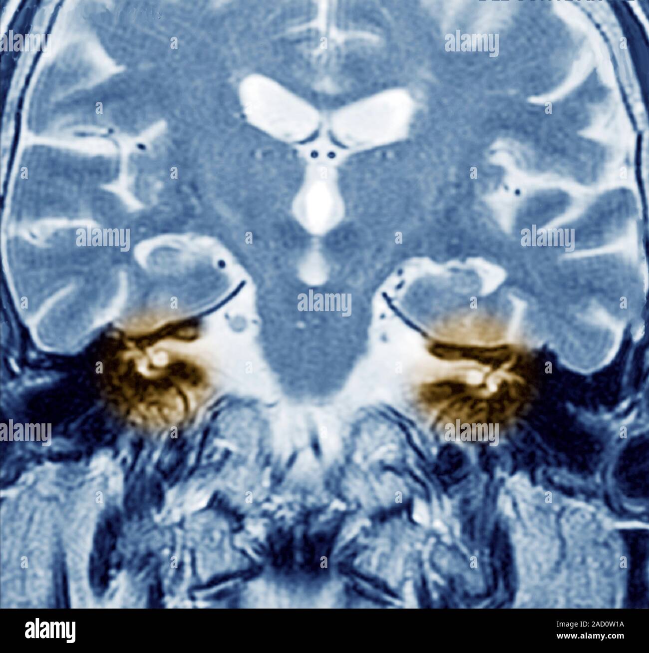 Auditory system. Coloured magnetic resonance imaging (MRI) scan of a ...