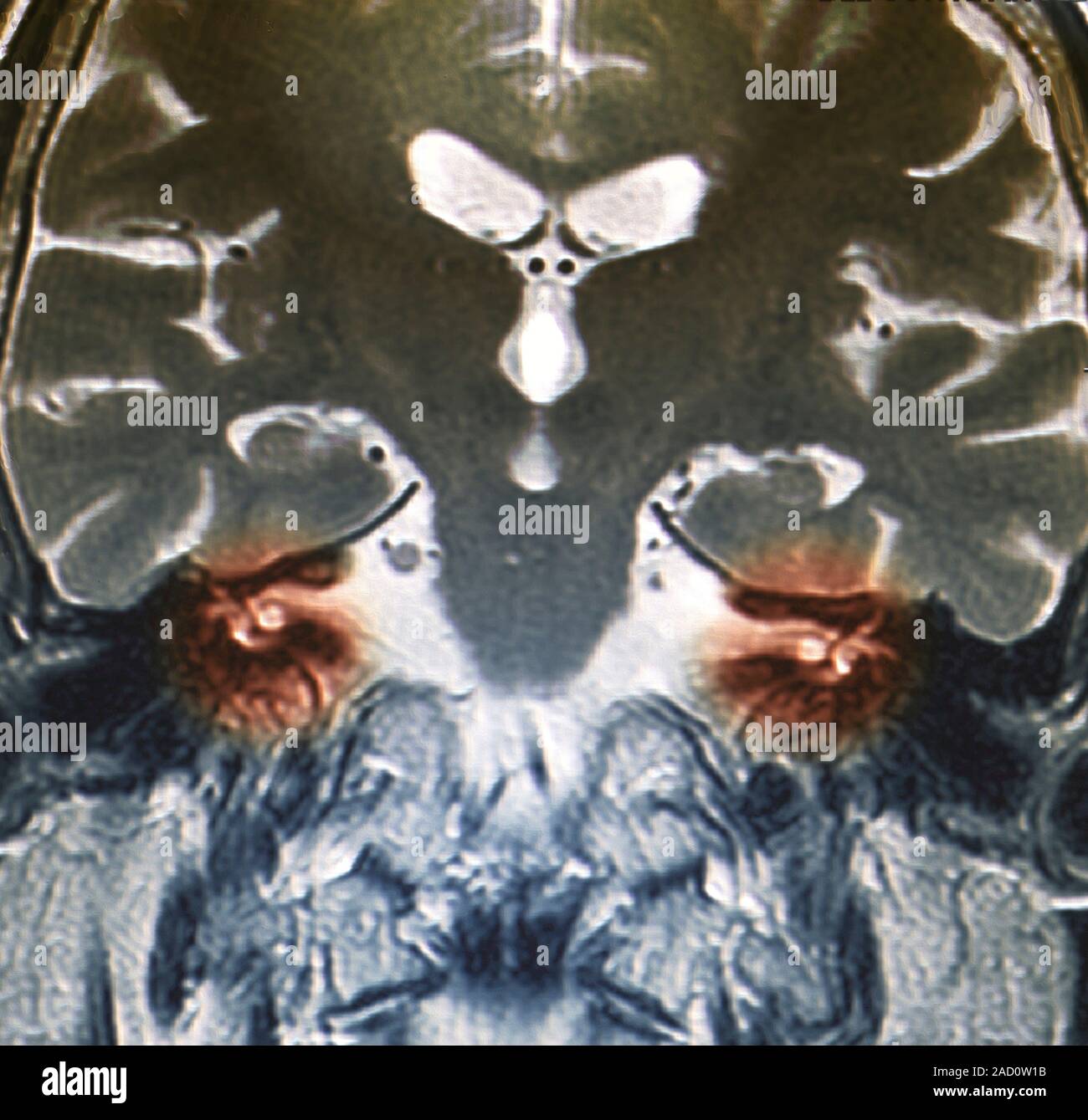 Auditory system. Coloured magnetic resonance imaging (MRI) scan of a ...