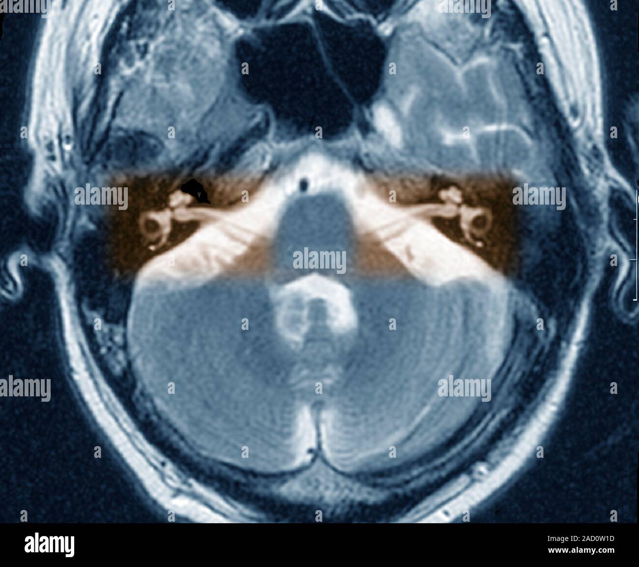 Auditory system. Coloured magnetic resonance imaging (MRI) scan of an ...