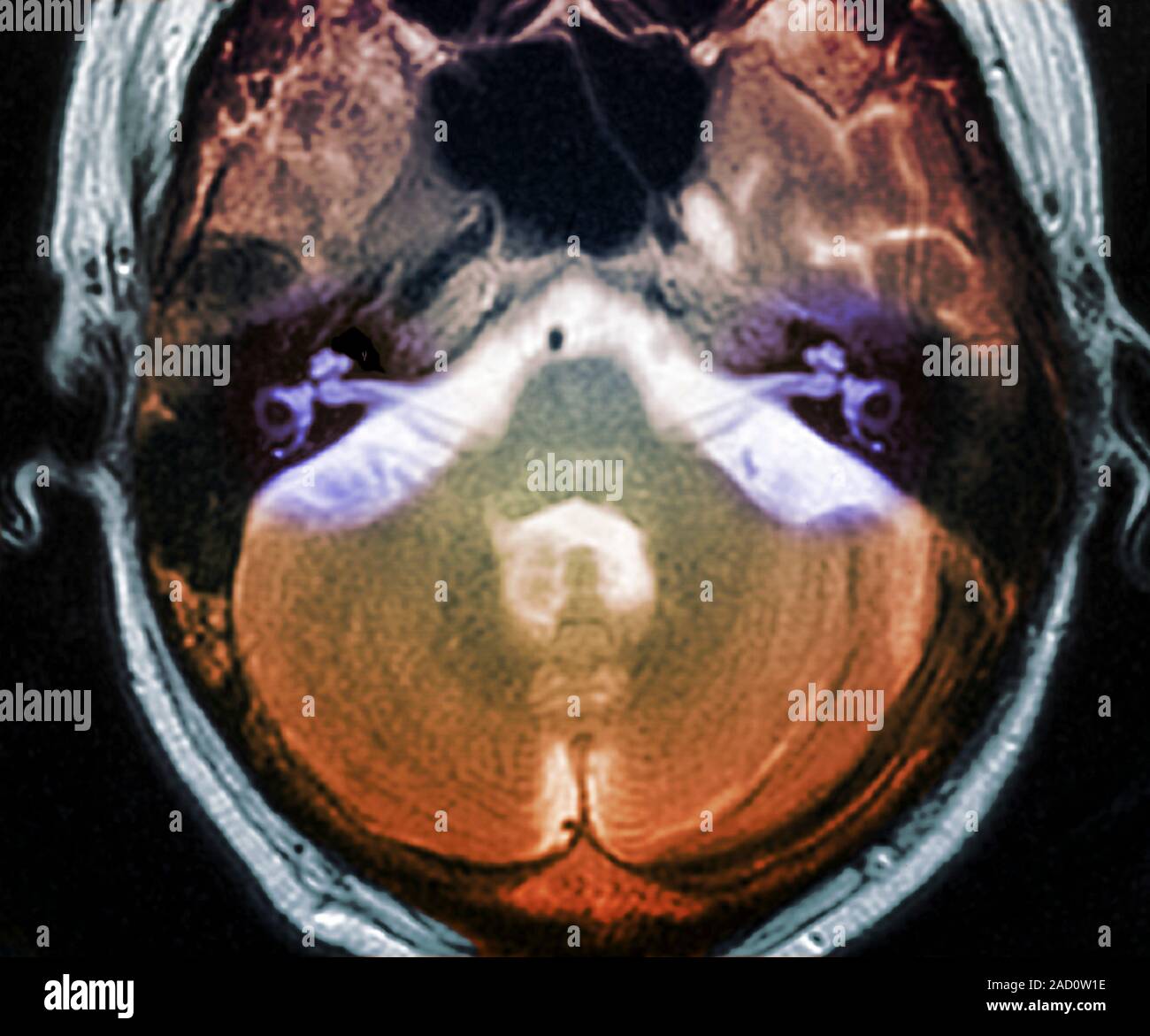 Mri Scan For Ears Nhs _ Nhs Mri Scan – EMWGH