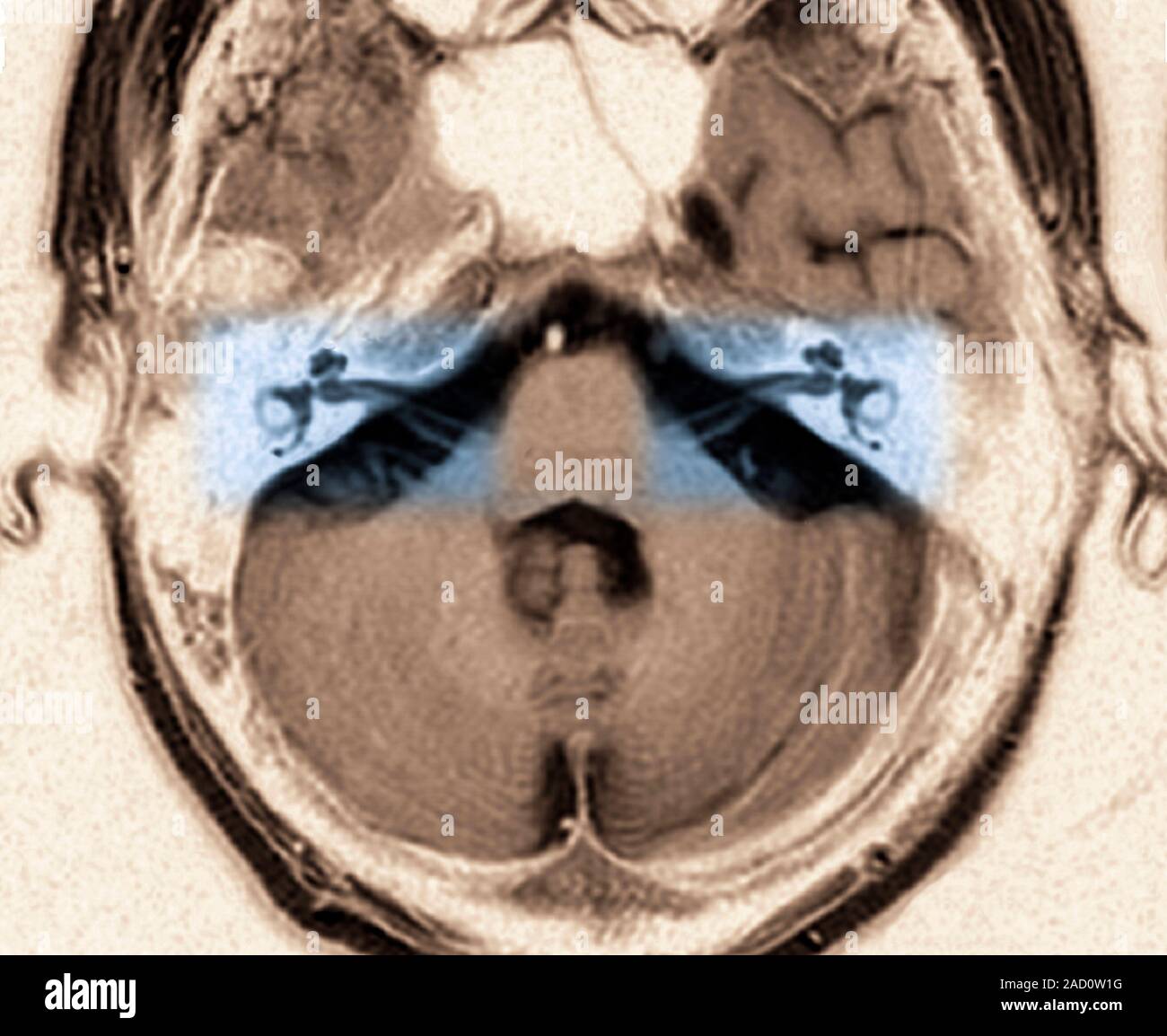 Auditory system. Coloured magnetic resonance imaging (MRI) scan of an ...